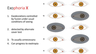 Exotropia | PPT