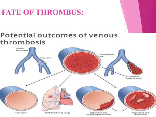 Thrombosis presentation - Pathology.ppt | Blood Disorders | Diseases ...