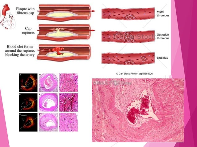 Thrombosis presentation - Pathology.ppt | Blood Disorders | Diseases ...