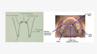 EXPANSION APPLIANCES IN ORTHODONTICS.pptx