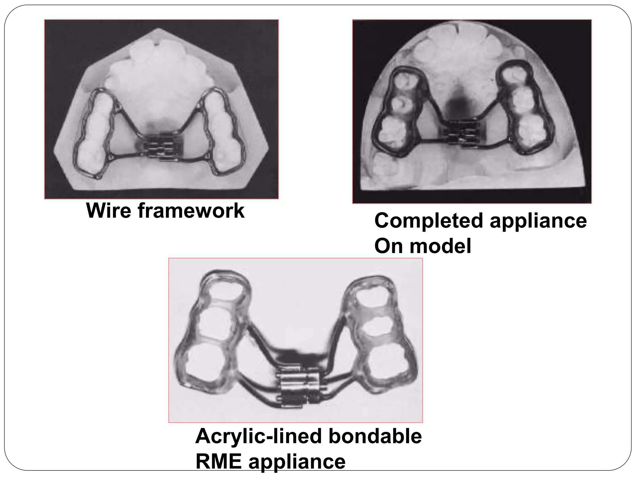 Expansion in orthodontics | PPTX