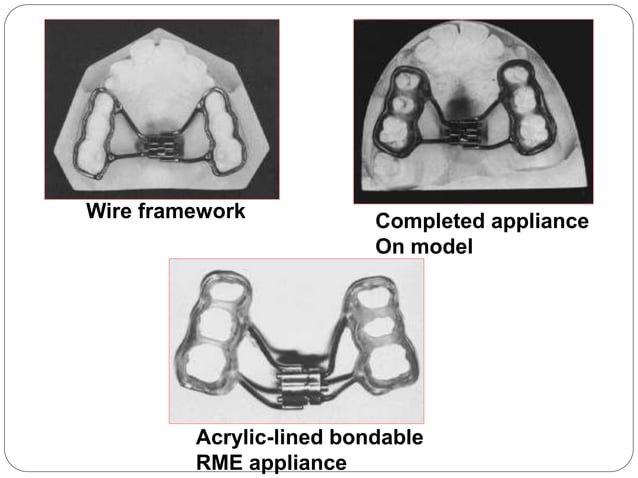 Expansion in orthodontics | PPTX | Dental Health | Diseases and Conditions
