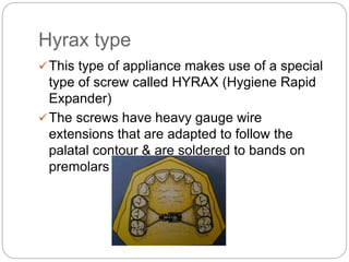 Expansion in orthodontics | PPT