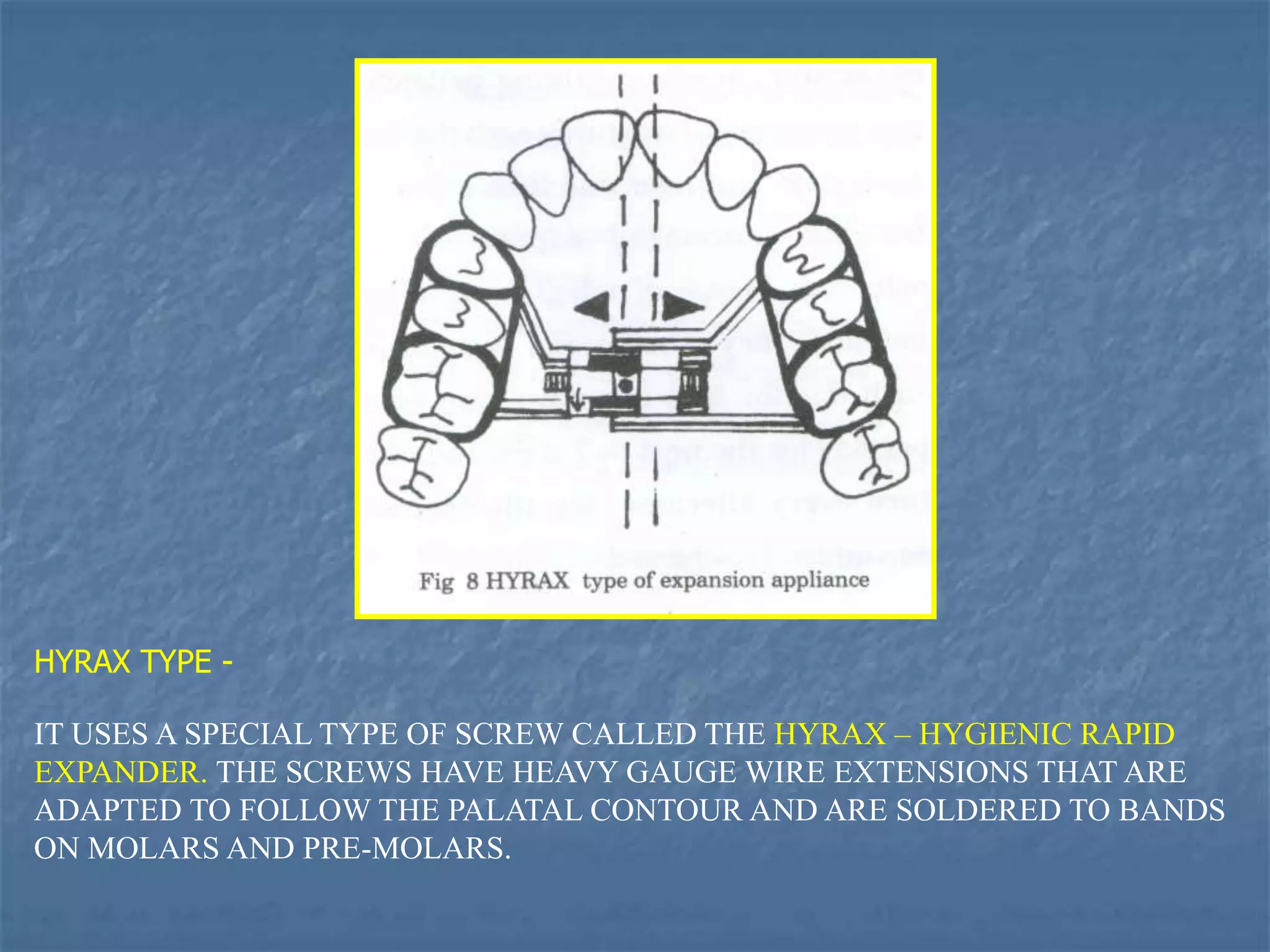 Expansion in orthodontics | PPT