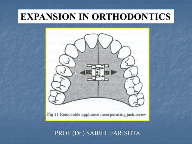 Expansion in orthodontics | PPT | Ear, Nose and Throat Conditions ...
