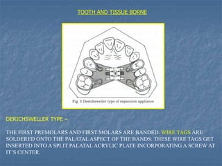 Expansion in orthodontics | PPT
