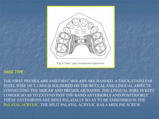 Expansion in orthodontics | PPT