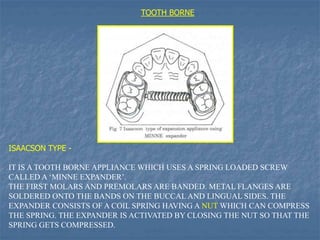 Expansion in orthodontics | PPT