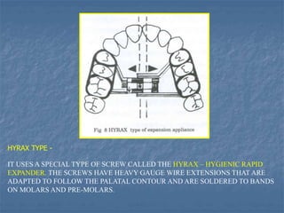 Expansion in orthodontics | PPT