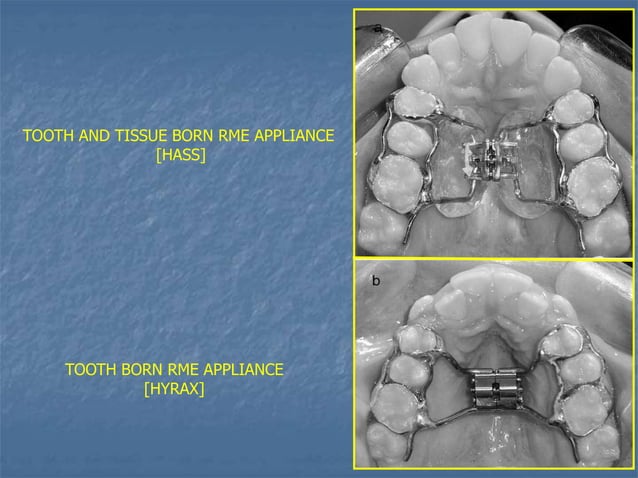 Expansion in orthodontics | PPT | Ear, Nose and Throat Conditions ...