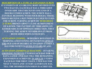 Expansion in orthodontics | PPT