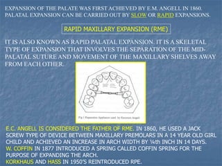 Expansion in orthodontics | PPT