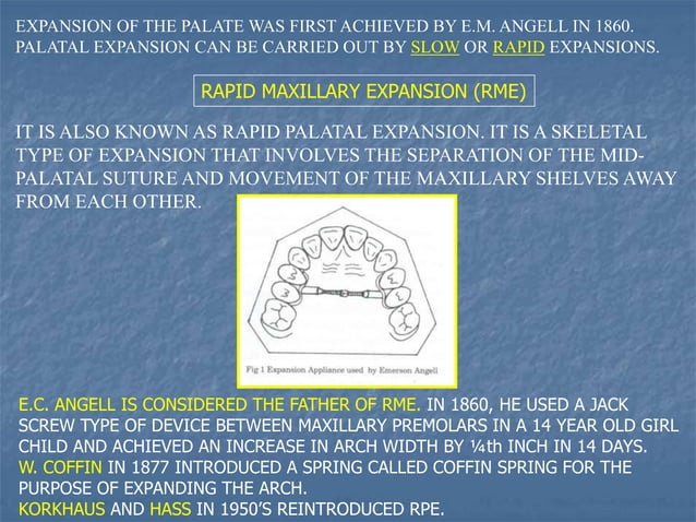Expansion in orthodontics | PPT | Ear, Nose and Throat Conditions ...