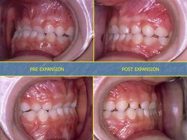 Expansion in orthodontics | PPT | Ear, Nose and Throat Conditions ...