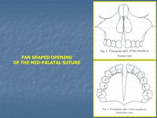 Expansion in orthodontics | PPT