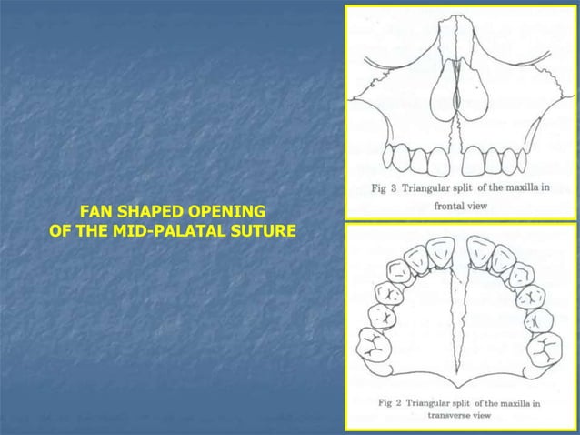Expansion in orthodontics | PPT | Ear, Nose and Throat Conditions ...