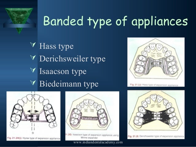 Expansion in orthodontics (2)