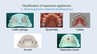Expansion vs Extraction in orthodontucs.pptx