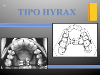 Expansores (Ortodoncia) | PDF