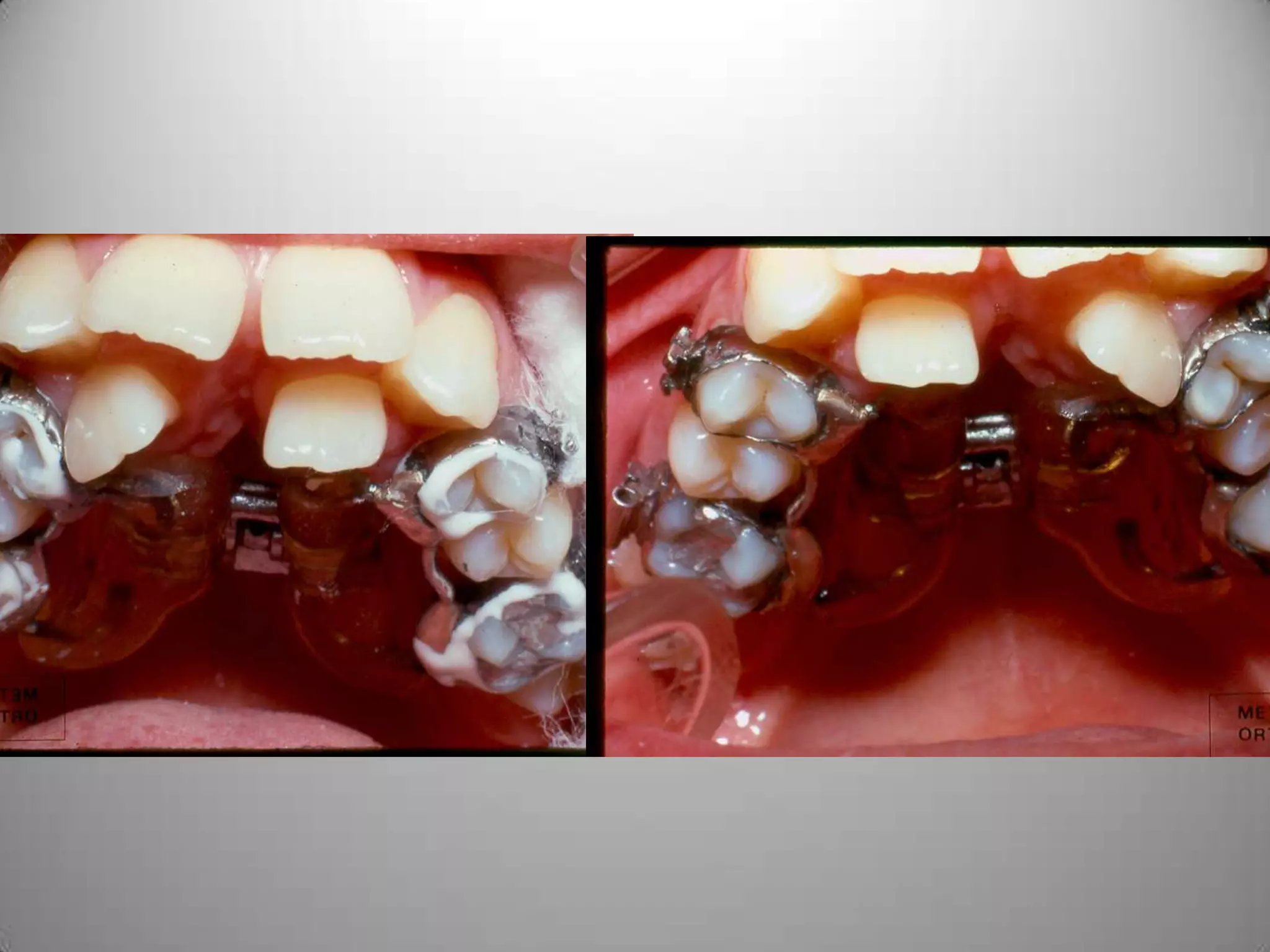 Expansores maxilares | PPT