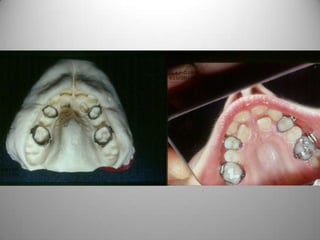 Expansores maxilares | PPTX