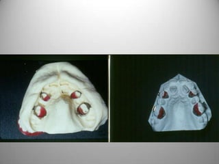 Expansores maxilares | PPTX