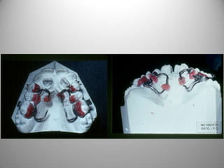 Expansores maxilares | PPTX