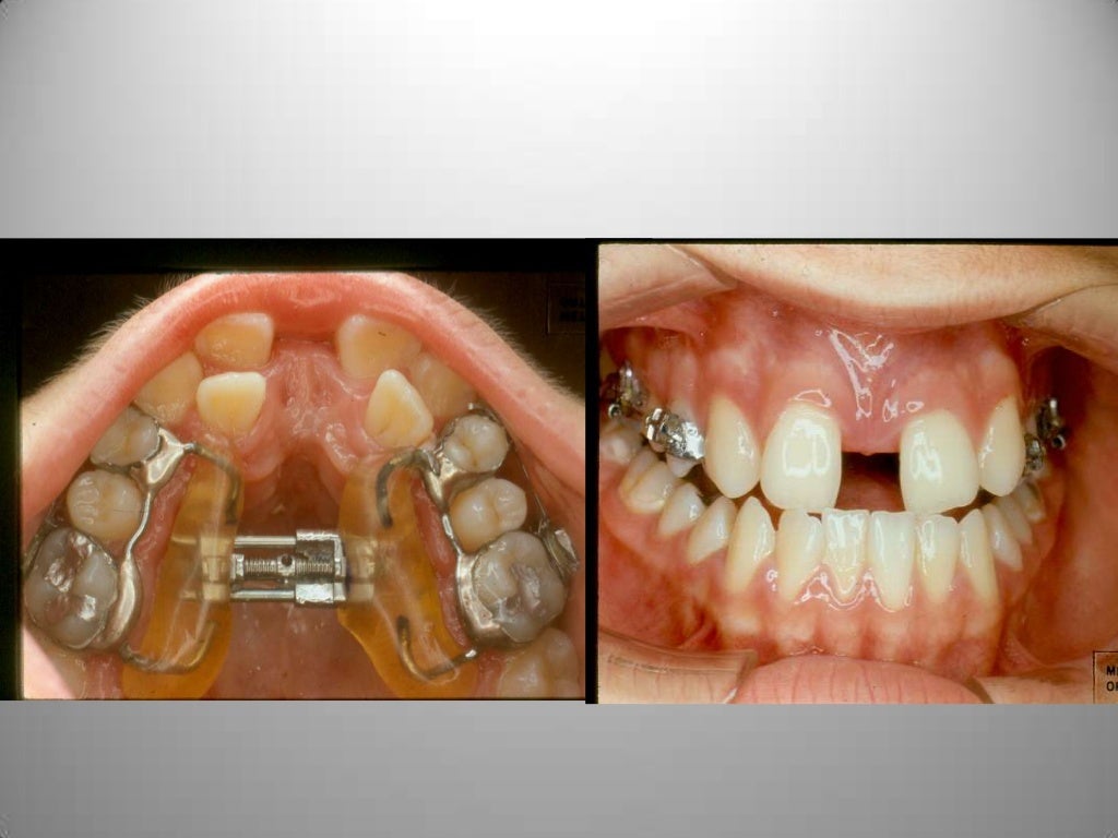 Expansores maxilares