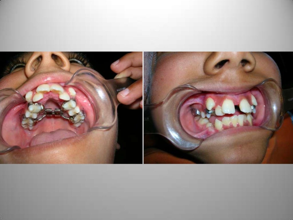 Expansores maxilares