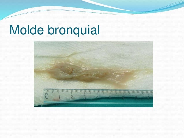 Estudio de Expectoracion