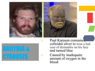 Argyria Paul Karason