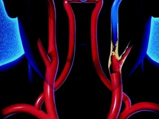 Explaining stroke 101 | PPT