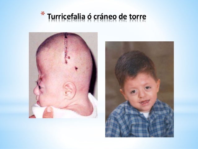 Exploración de craneo