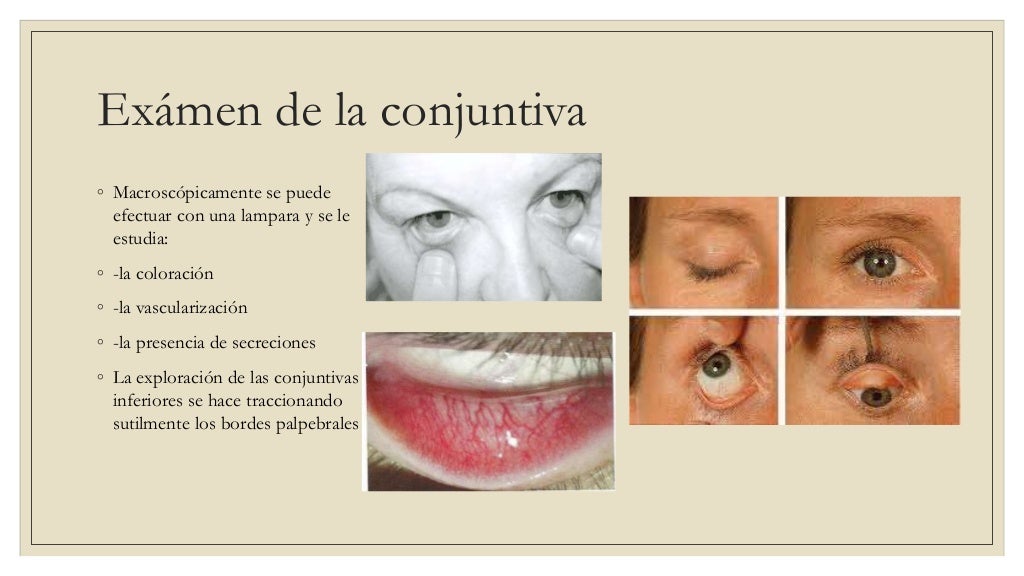 Exploración De La Conjuntiva