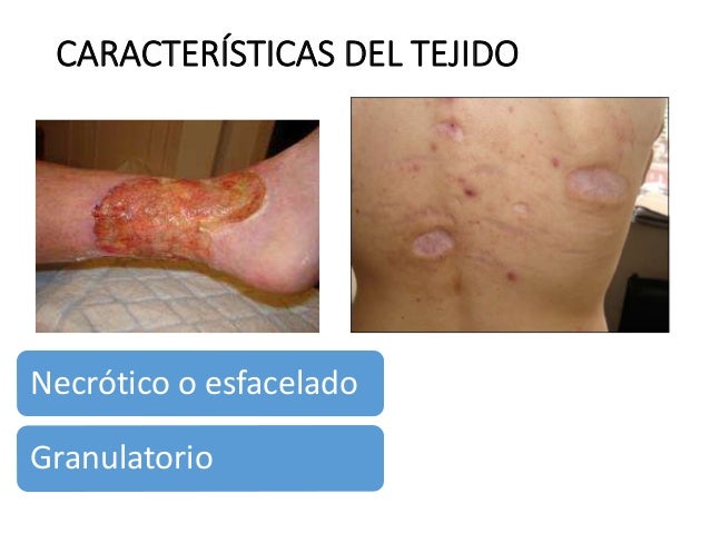 EXPLORACIÓN DE HERIDAS