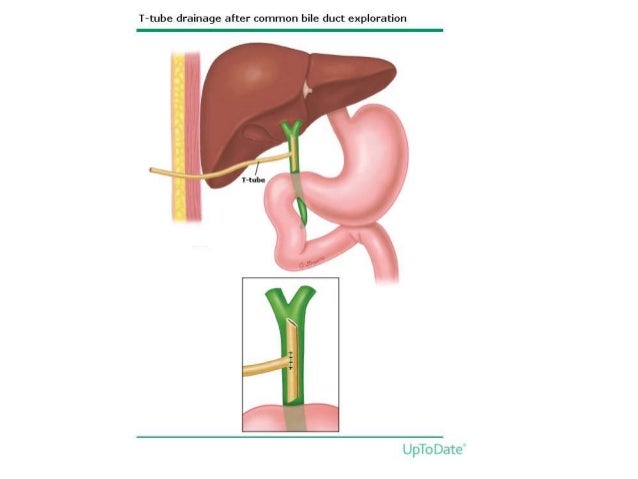 Exploracion de vía biliar