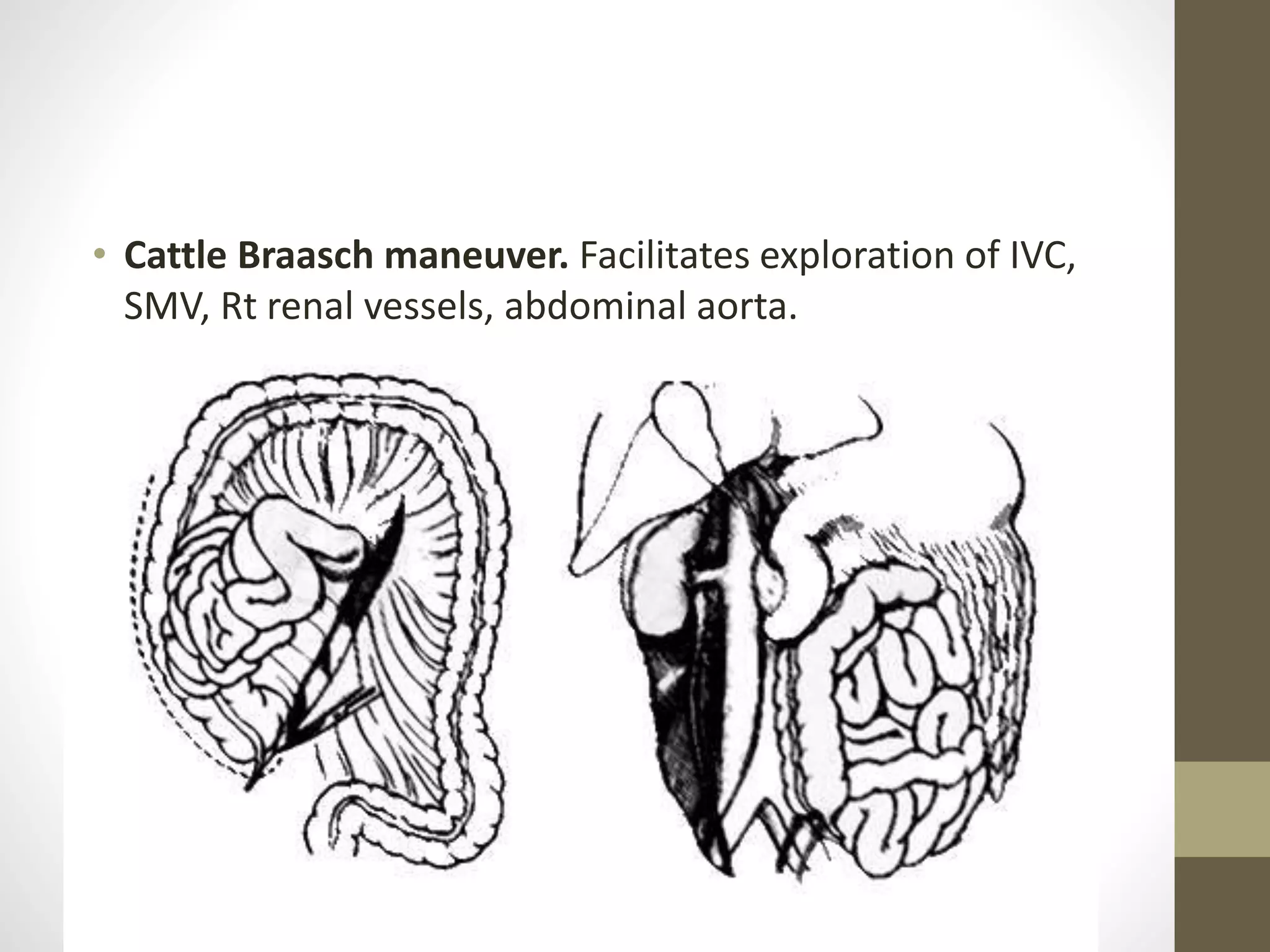 Exploratory laprotomy | PPTX