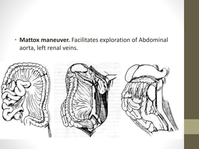 Exploratory laprotomy | PPTX