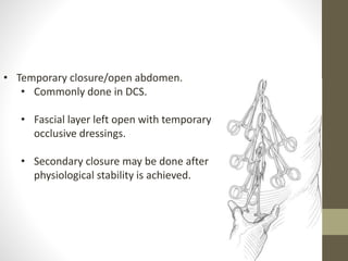 Exploratory laprotomy | PPTX