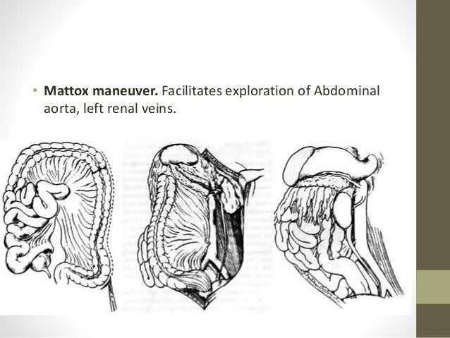 Exploratory laprotomy