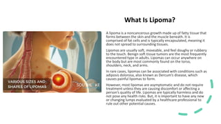 Exploring Lipoma Reasons - Causes, Symptoms, and Treatments.pdf