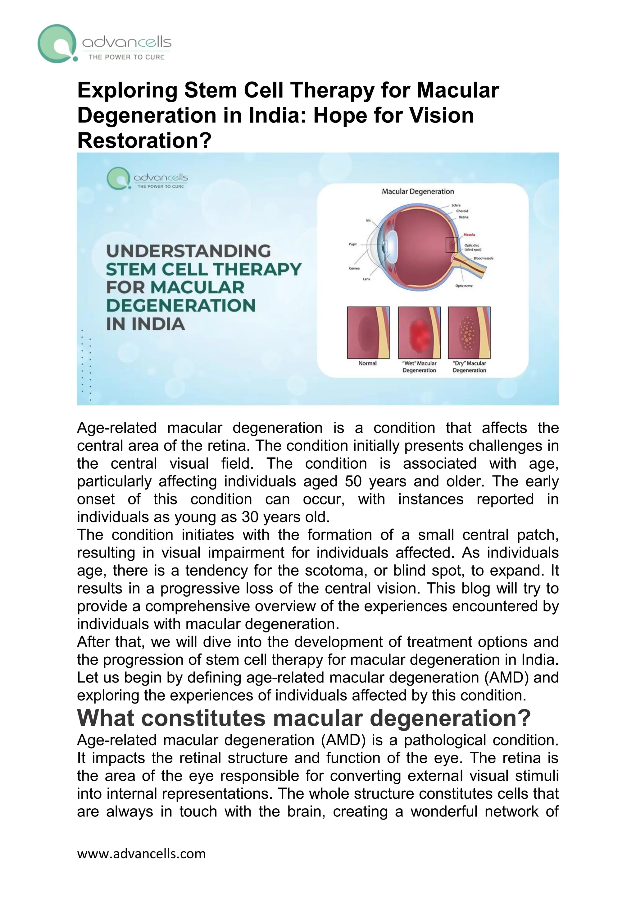 Exploring Stem Cell Therapy for Macular Degeneration in India | PDF