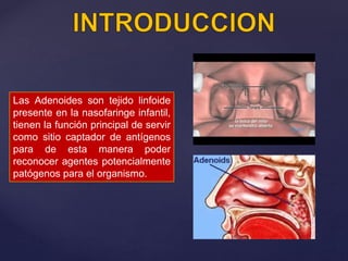 Adenoiditis | PPTX