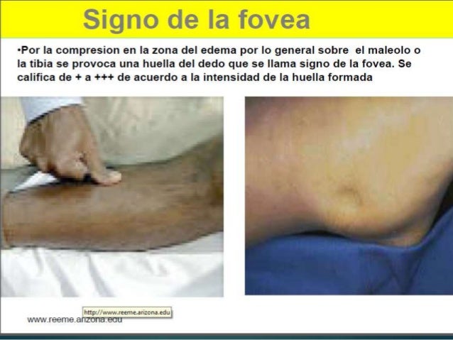 Enfoque diagnóstico Edema Dr. Elenit Días R1 Medicina Interna