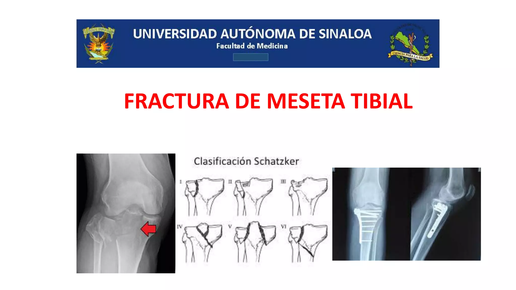 Fracturas de tibia proximal | PPTX