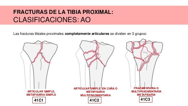 Fracturas de tibia proximal