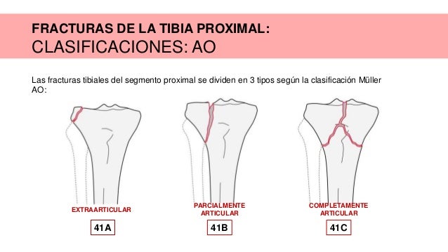 Fracturas de tibia proximal
