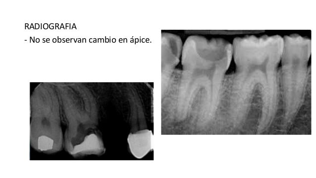 Pulpitis, quiste periapical y absceso periapical