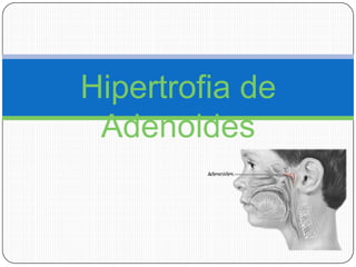 Hipertrofia adenoidea: causas, síntomas y tratamiento | PPT