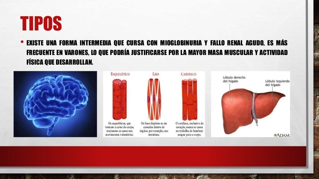 Enfermedad de Mcardle